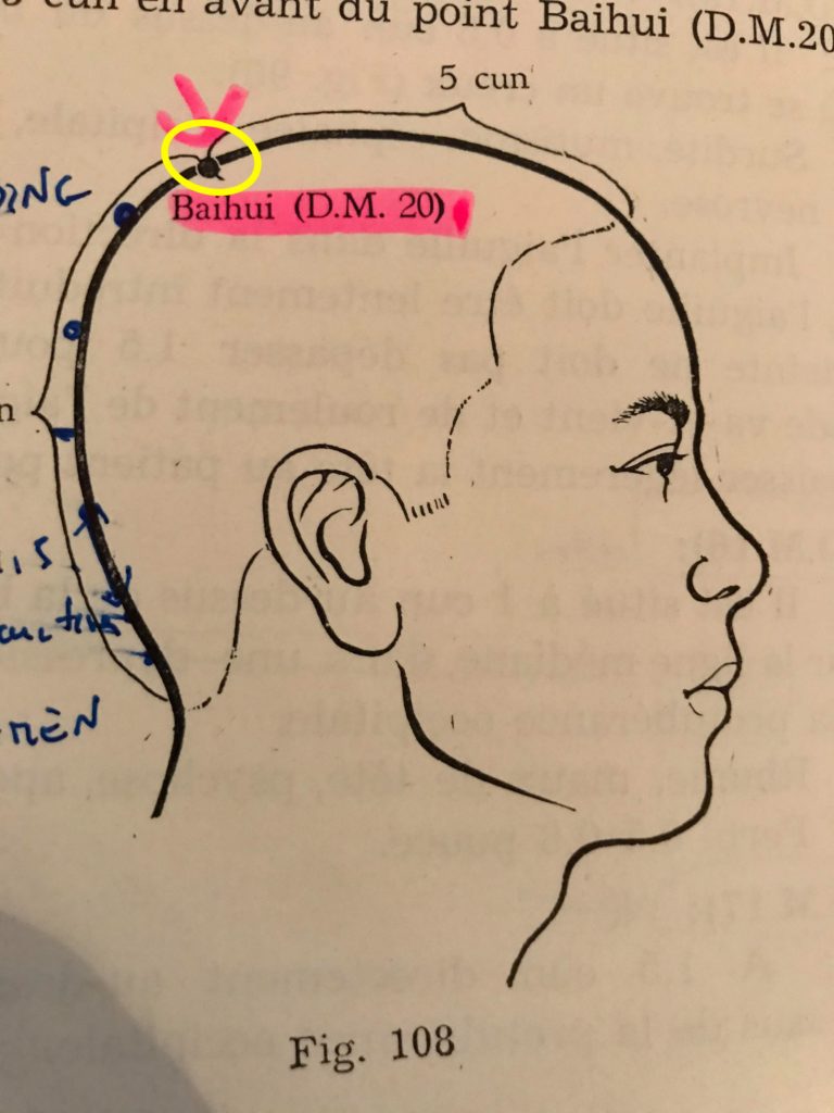 point-acupuncture-baihui – Médecine Chine